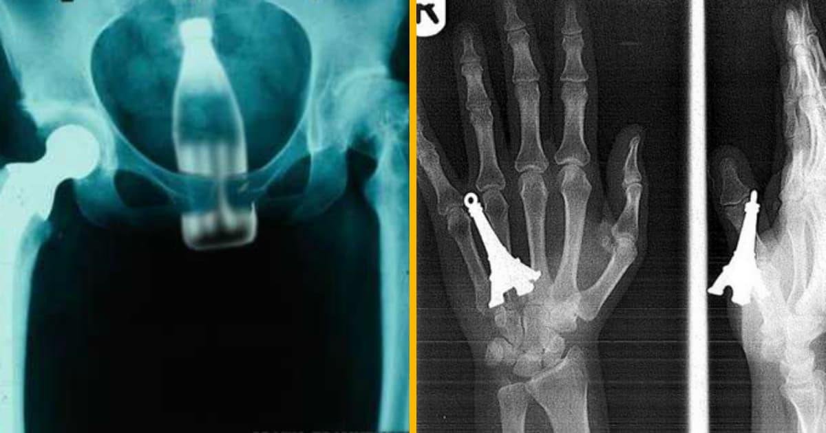 Top 20 des objets bizarres retrouvés dans le corps de patients, le tout ...
