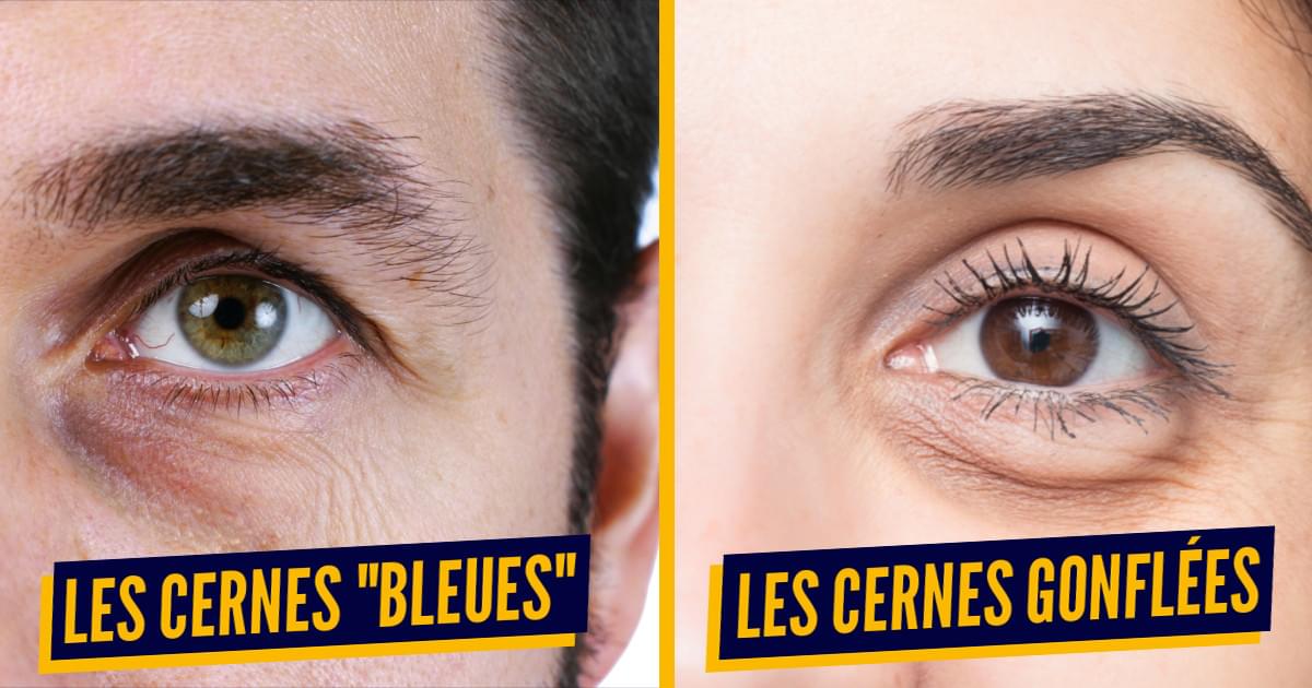 Top 8 des différents types de cernes en illustrations, quand la fatigue ...